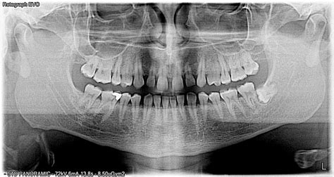 Impacted Wisdom Teeth