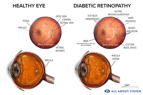 Diabetes Related Retinopathy Causes Treatment Signs And Symptoms