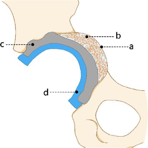 The Impaction Bone Grafting Technique A Internal Layer Of The