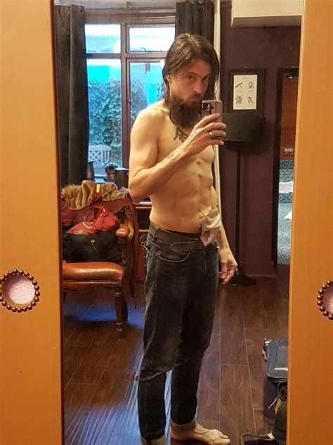 Life With Ileostomy Bag