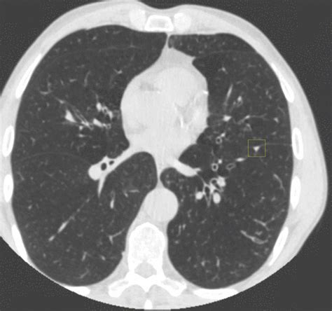 Lung Nodule Management In Low Dose Ct Screening For Lung Cancer Lessons From The Nelson Trial
