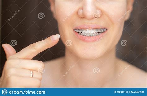 The Girl Points Her Finger At The Even And White Teeth With Braces