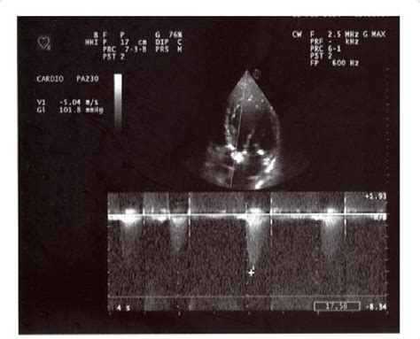 Mr Peak Aortic Transvalvular Gradient At Cw Doppler Download Scientific Diagram