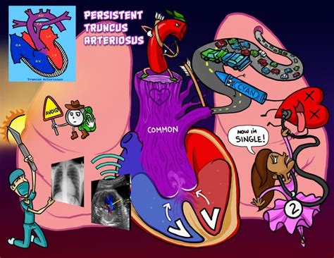 Truncus Arteriosus Osmosis