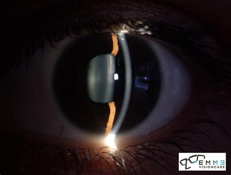 Comprehensive Eye Examination Using Slit Lamp Biomicroscopy