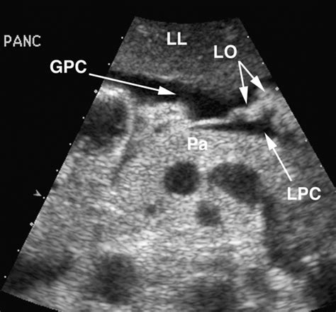 Sonographic Anatomy Of The Gastrohepatic Ligament Desai 2010