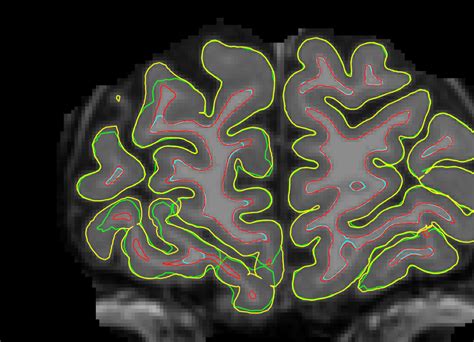 Freesurfer V Dev Version Optimization Of Recon All For HCP Data Issue Washington