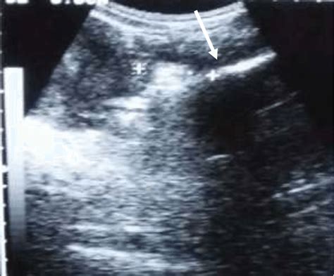 Ultrasound Picture Of Migrated Iud The End Of The Device Is Visualized