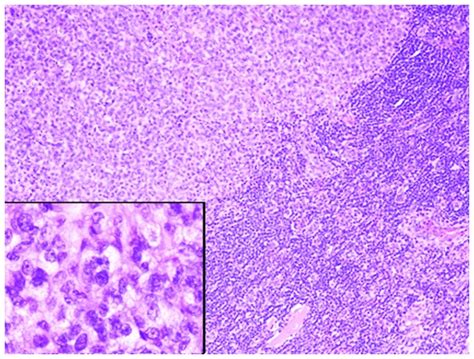 Histopathological Features Of The Sentinel Lymph Node Metastatic Download Scientific Diagram