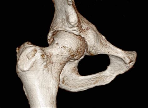 Hip 3d Bone Reconstruction From Mri Photograph By Science Photo