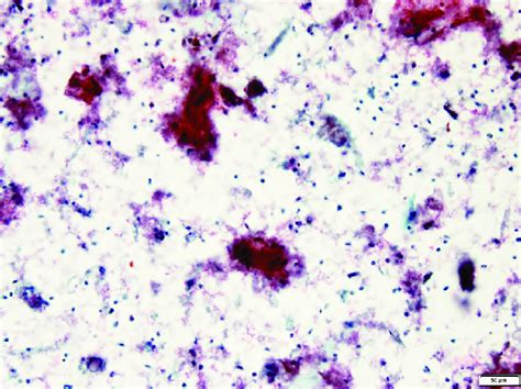 Cervical Smear Showing A Background Of Hemorrhagic Diathesis Figure 2