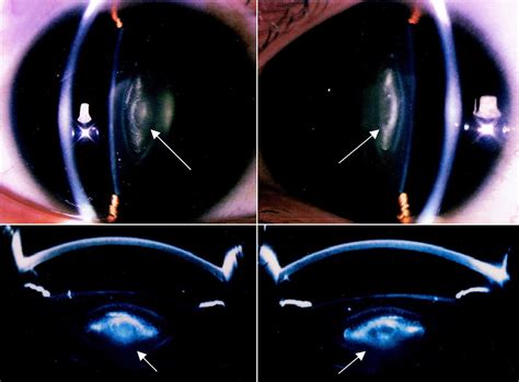 Wavefront Analysis Of Higher Order Aberrations In Patients W