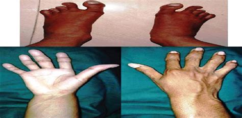 Multiple Impacted Permanent Teeth An Indicator For Early De