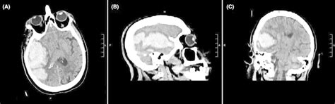 Preoperative Brain Ct Axial A Sagittal B And Coronal C Images