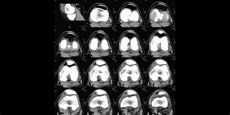 Ct Scans Elective Knee