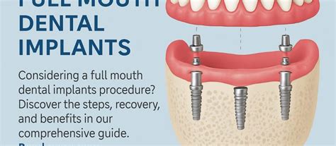 Full Mouth Dental Implants Procedure What To Expect Dental Implants