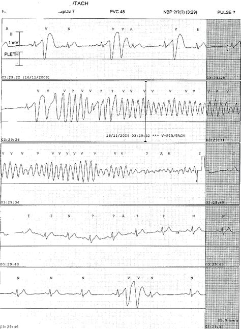 Ventricular Ectopy And A Salvo Of Polymorphic Ventricular Tachycardia