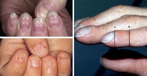 10 Things Your Nails Can Reveal About Your Thyroid Heart And Cancer