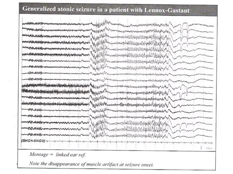 Neuro Physiology Of Seizures And Eeg Pedaitric Neurologist Dr Amit