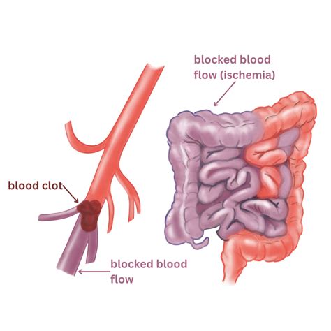 Gastrointestinal Ischemia Access Care Vascular Buffalo Ny