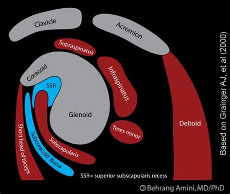Subcoracoid Bursitis Wikism Sports Medicine Wiki