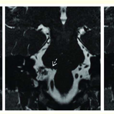 Arterial Contact Along The Proximal Cisternal Segment Of The Facial