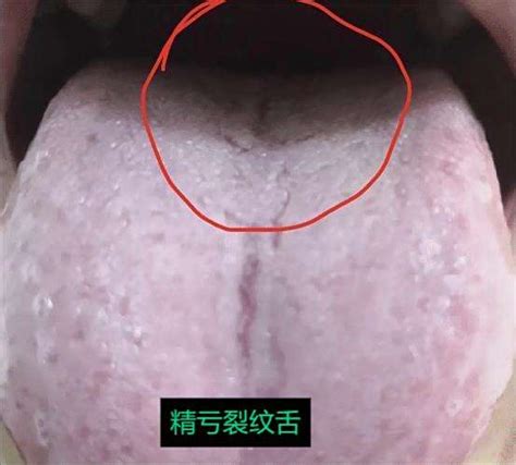 裂纹舌不只是脾虚，中医教你分清楚、怎么治