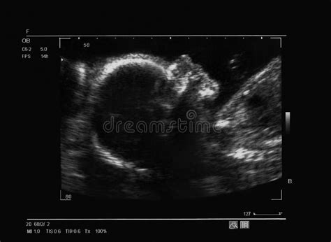 Ultrasound Of A Fetus At 26 Weeks Stock Photo - Image of healthcare, examination: 28135834