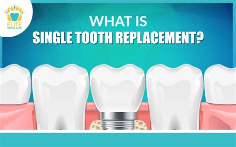 What Is A Single Tooth Replacement Elite Dental Care