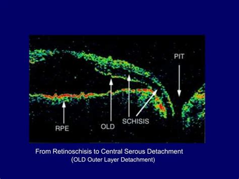 Retinoschisis And Retinal Detachment Ppt Eye And Vision Conditions