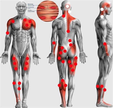 Muscle Knots Trigger Points Eps Chiropractic Scientists