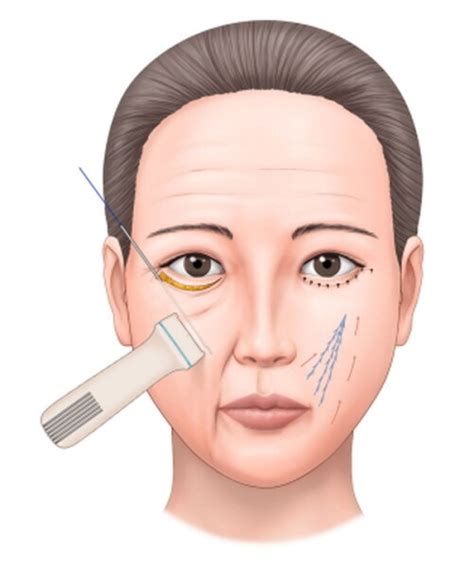 중년 눈밑 처짐과 팔자 주름초음파·실리프팅 접목한 치료 옵션 제시