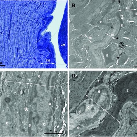 Case 1 Trabeculectomy Sample From The Right Eye A Light Micrograph Download Scientific