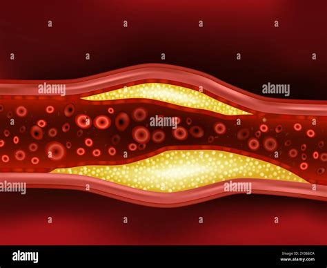 Cholesterol Plaque In Artery Atherosclerosis Stock Vector Image And Art Alamy