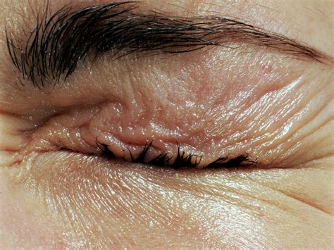 Blepharitis Sore Itchy Red Eye Causes And Symptoms Causes
