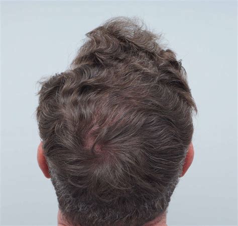 Dr B Farjo 2100g Fue Front And Crown Tweak Hair Loss Forum Hair Transplant Forums