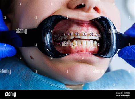 Extender For Teeth Teeth Of A Woman With Braces At A Dentist Appointment Orthodontic Treatment