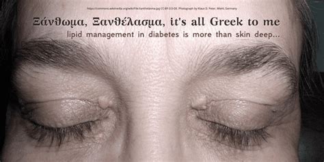 Xanthoma Xanthelasma Its All Greek To Me Lipid Management In