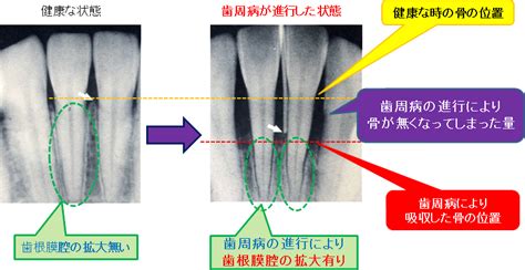 8．歯周病の重症度（進行度）を調べる検査方法 江南市の歯医者 緑が丘歯科医院 歯周病・矯正・インプラント無料相談実施中