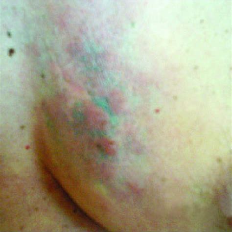 A Isolated Extramedullary Relapse Of All In The Skin Of Lower Limbs