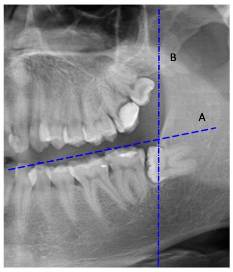 Inverted Impacted Wisdom Tooth