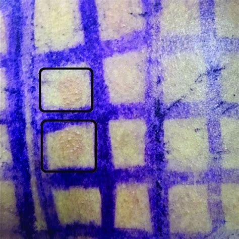 Patch Test Same Patient Shown In Figure 4 Showed Positive Reaction To