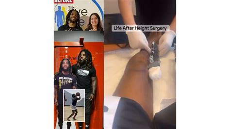 Man Who Spent 81k On Height Surgery Grows From 55” To 60” Now