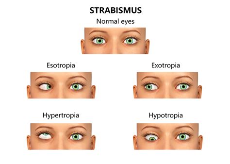 Strabismus Its Different Types And Risk Factors Doral Health