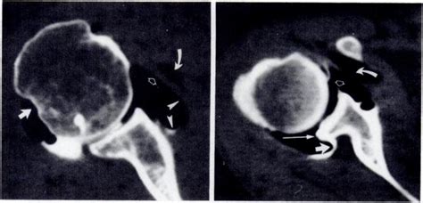 Double Contrast Ct Arthrogram Of Upper Shoulder Joint Shows Posterior Download Scientific