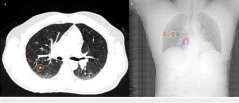 The Figure Shows The Simulation Ct Scan And The Digitally Reconstructed