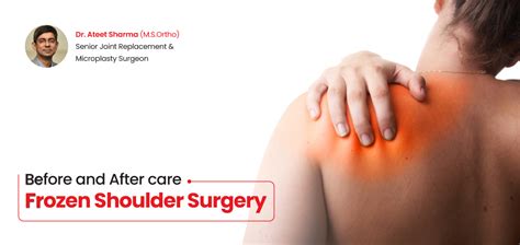 Before And After Frozen Shoulder Surgery Real Patient Journeys