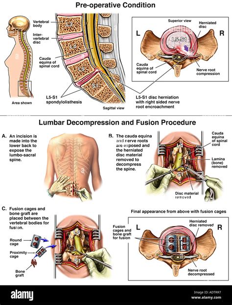 L4 L5 Back Fusion Surgery Spinal Fusion Recovery Timeline Exercises