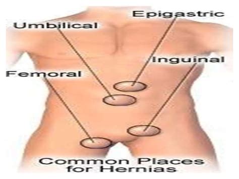 Hernia Classification Of Hernias In Different Formsppt