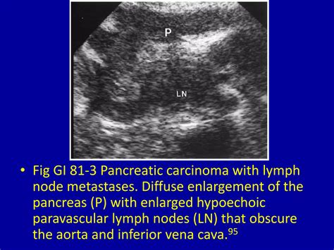 81 Pancreatic Masses On The Ultrasound Pptx